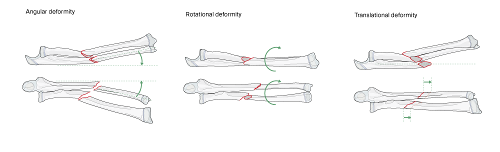 Pediatric forearm fracture care | Surgical Illustration | Tamara Aepli