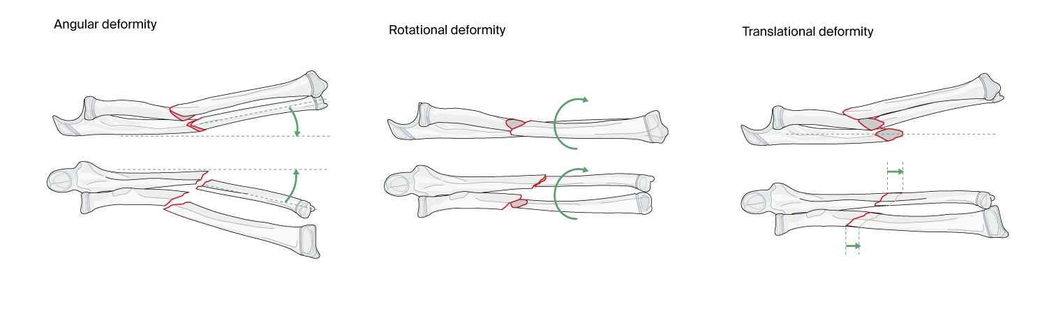 Pediatric forearm fracture care | Surgical Illustration | Tamara Aepli