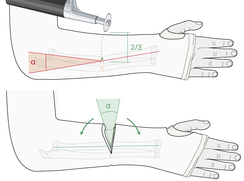 Pediatric forearm fracture care | Surgical Illustration | Tamara Aepli
